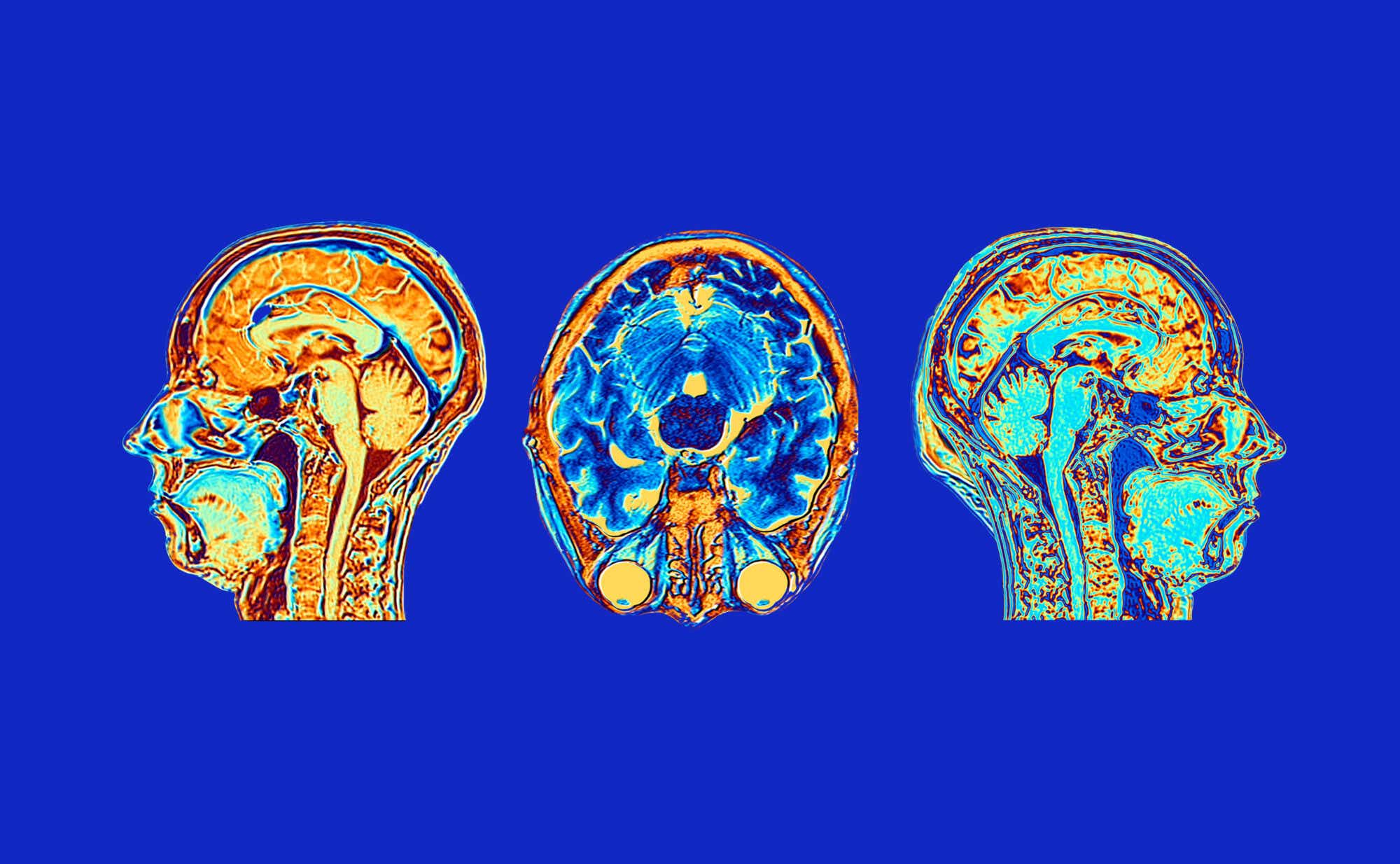 Possible Alzheimer's Research Fraud Revealed by Matthew Schrag