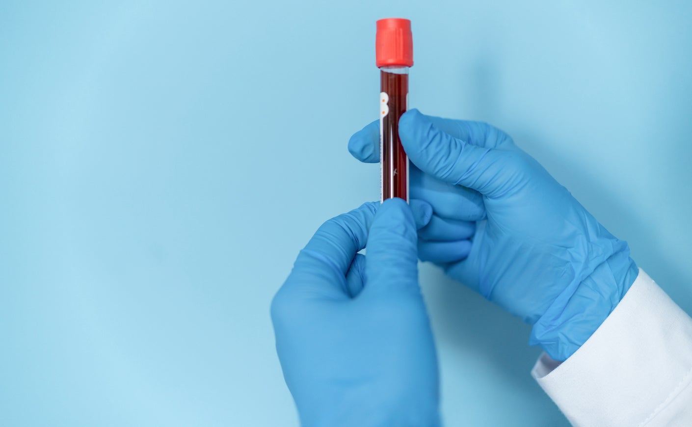 A Blood Test for Cancer May Be the Future of Cancer Screening